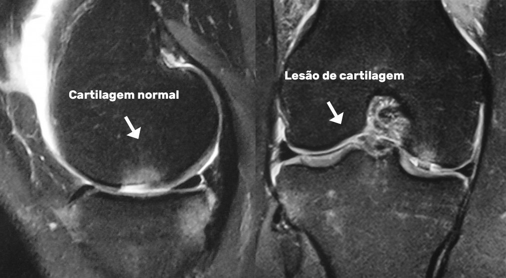 LESÃO CONDRAL Dr. Rodrigo Medeiros Ortopedista